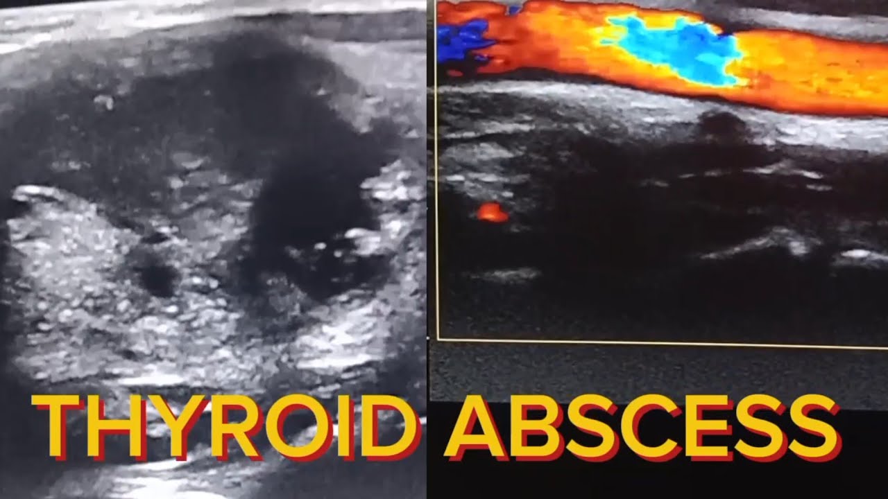 "Thyroid Abscess Ultrasound - YouTube