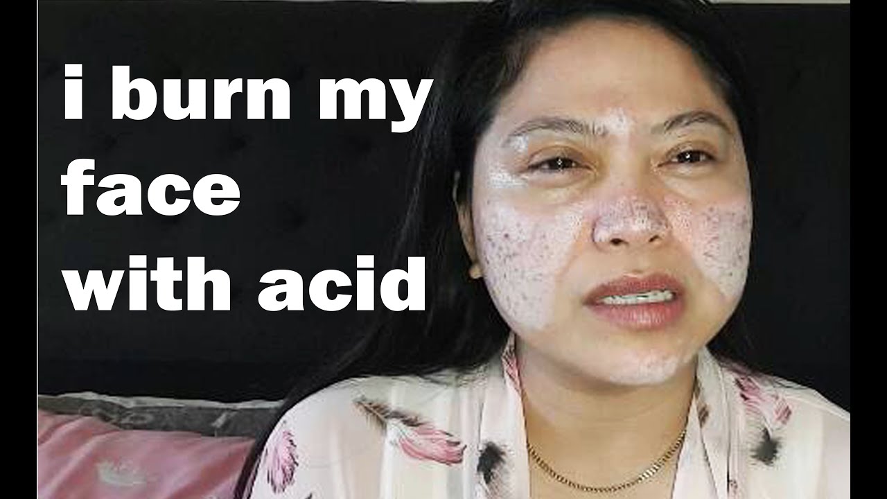 DIY TCA 25% SPOT PEELING/Treating Hyperpigmentation/BelleLife Tv - YouTube