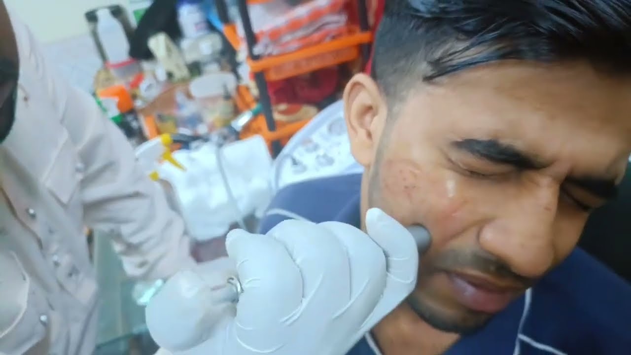 HIJAMA CUPPING THERAPY FOR CLEAR SKIN | BENEFITS OF HIJAMA | HIJAMA NO ...