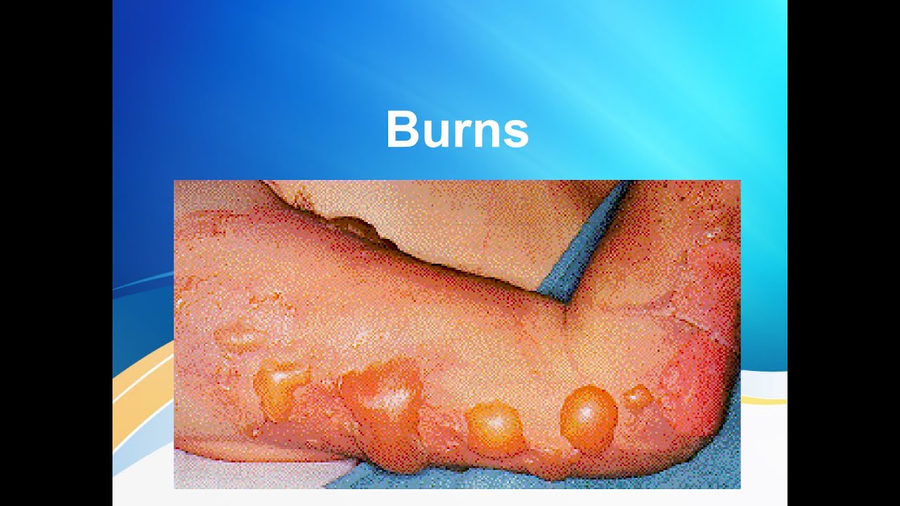 Burns: Classification and extent - YouTube