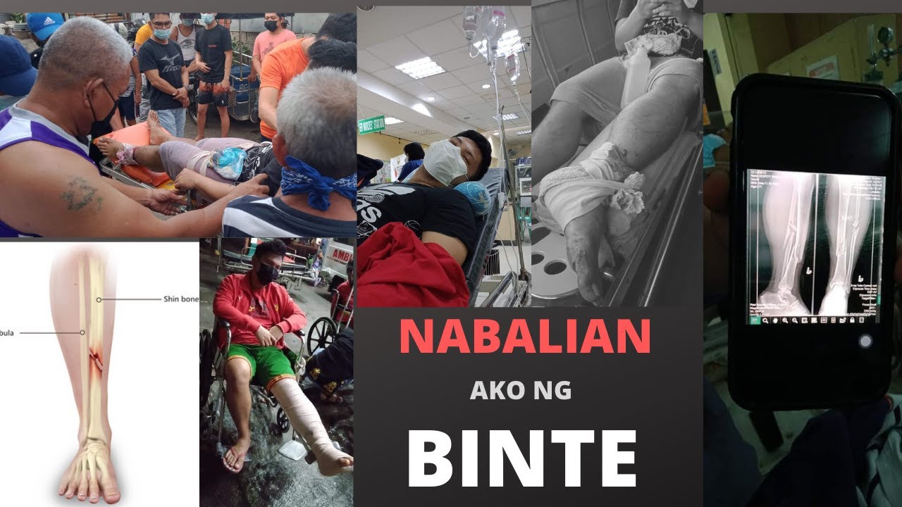 NABALIAN AKO NG BUTO SA BINTE TIBIA & FIBULA BONE FRACTURE - YouTube