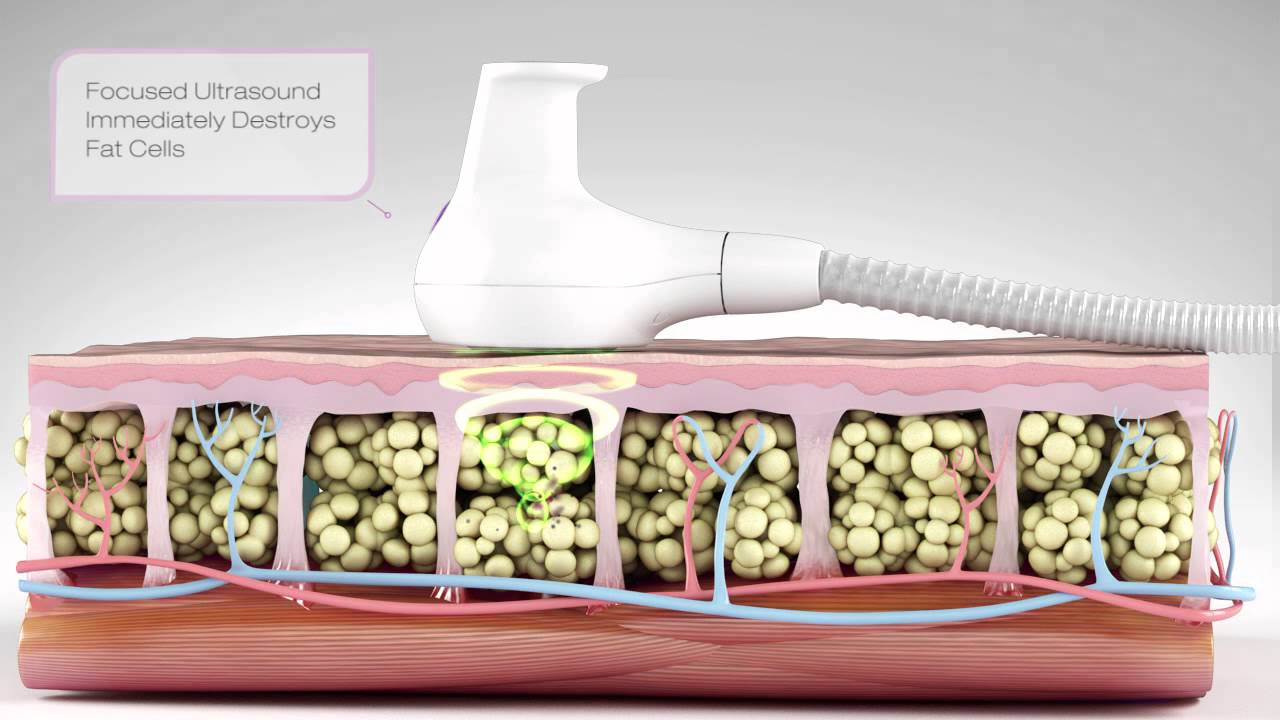 ultrashape body contouring - YouTube
