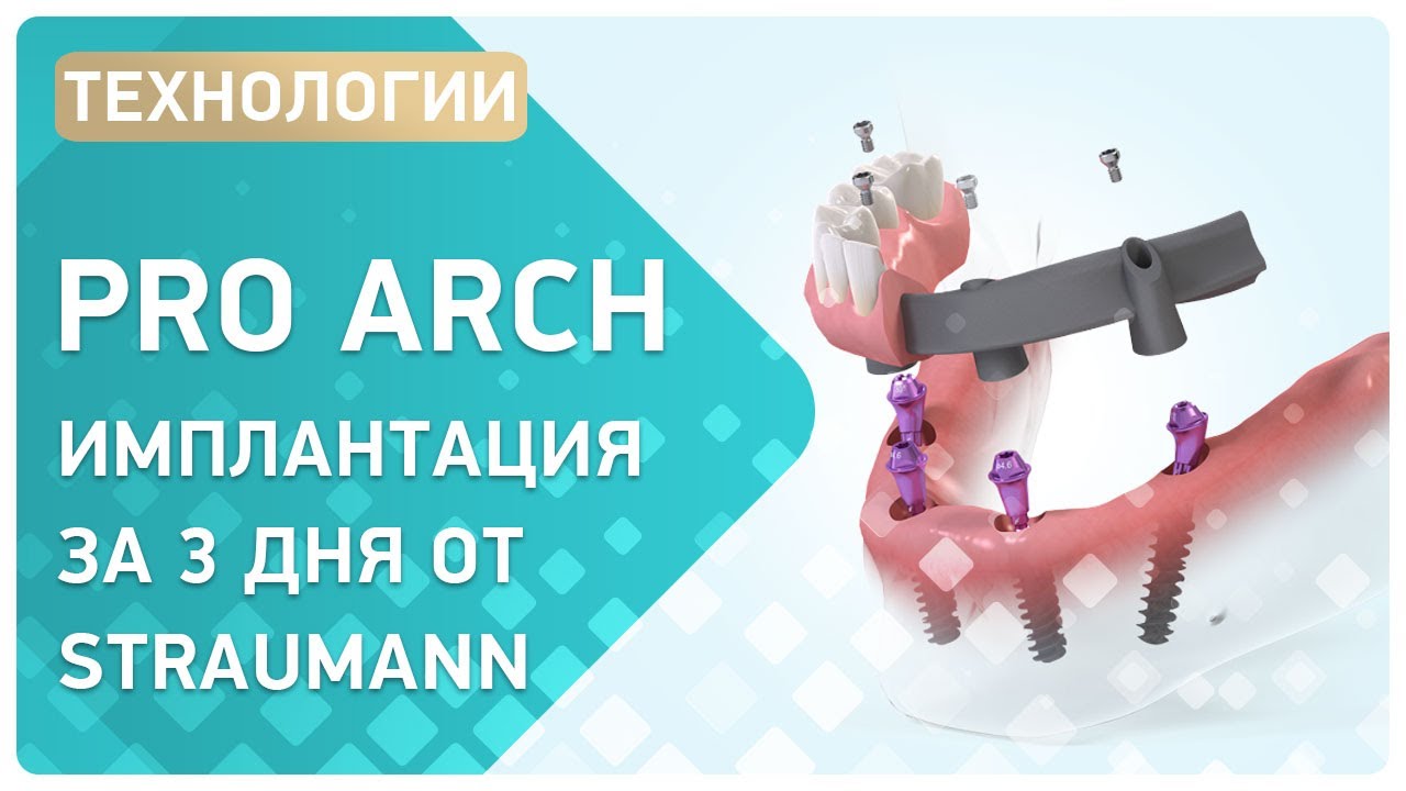 Технология Pro Arch 👉 все зубы за 3 дня на имплантах Straumann - YouTube