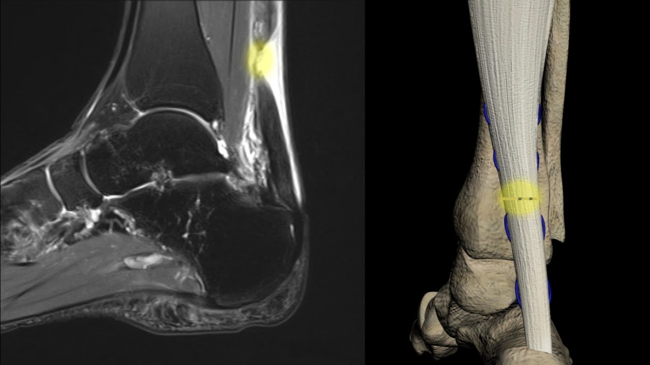 Achilles Rupture? Fix it FAST with This Repair Method! - YouTube