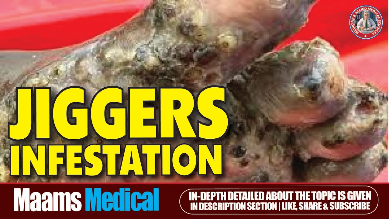 Jigger Infestation Treatment: Step-by-Step Foot Care Guide - YouTube