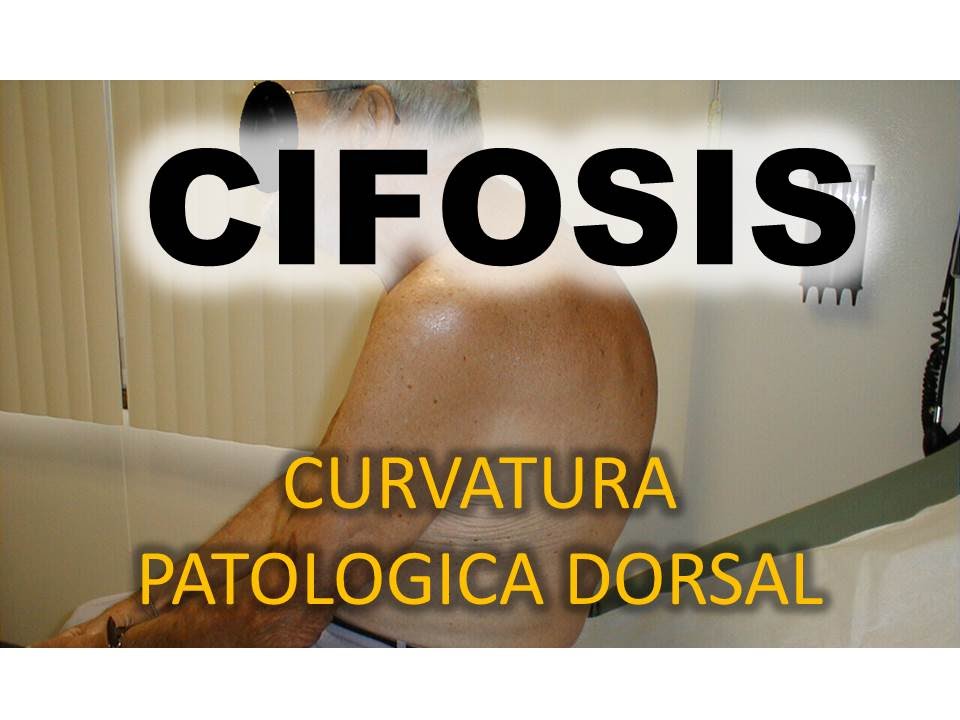 CIFOSIS - CURVATURA PATOLÓGICA DORSAL - YouTube