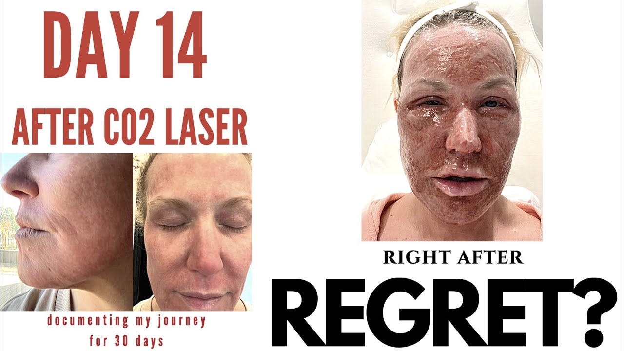 DAY 14- the REALITY of the extreme C02 LASER- being vulnerable! - YouTube