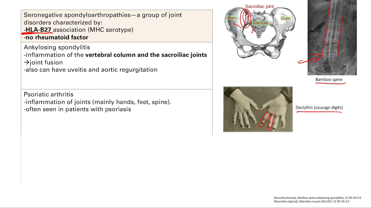 Seronegative Spondyloarthropathies | MSK | Step 1 Simplified - YouTube