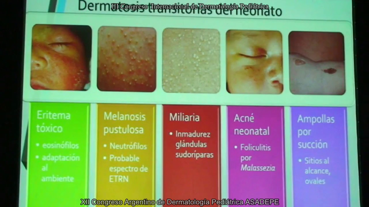Eritema Tóxico Vs Melanose Pustulosa