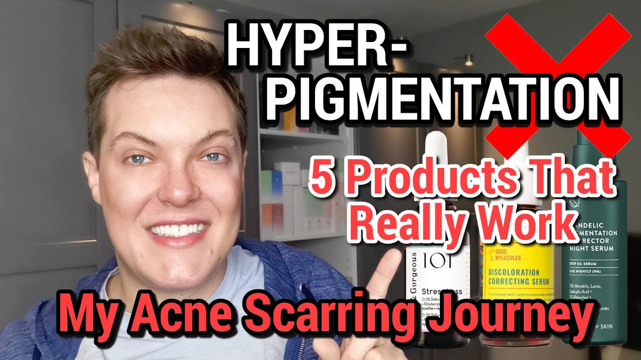 Top 5 Ways To FADE HYPERPIGMENTATION - These Actually Work - YouTube