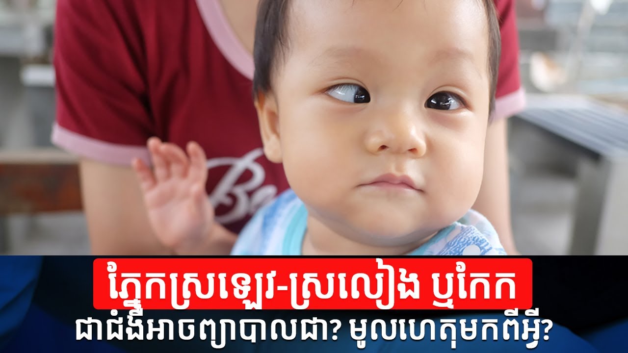 ភ្នែកស្រឡេវ-ស្រលៀង ឬកែក ជាជំងឺអាចព្យាបាលជា | Strabismus, Squint Or ...