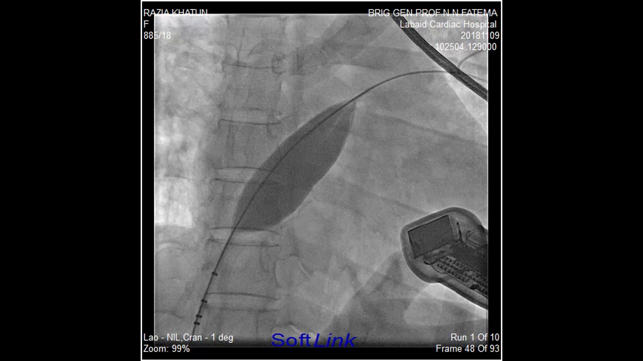 Razia Begum 34 Yrs 60 Kg Large ASD II Balloon Sizing Angio Show - YouTube