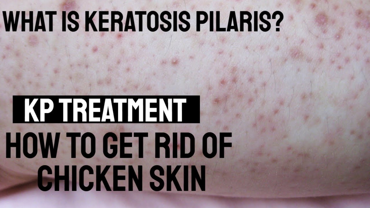 What Is Keratosis Pilaris? KP Treatment - How To Get Rid Of Chicken ...