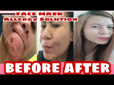 Face Mask Allergic Reaction Remedy/ Tigyawat sa Mukha Paanu mawala I ...