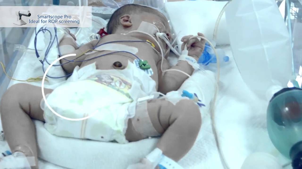 ROP screening with Optomed Smartscope PRO - YouTube