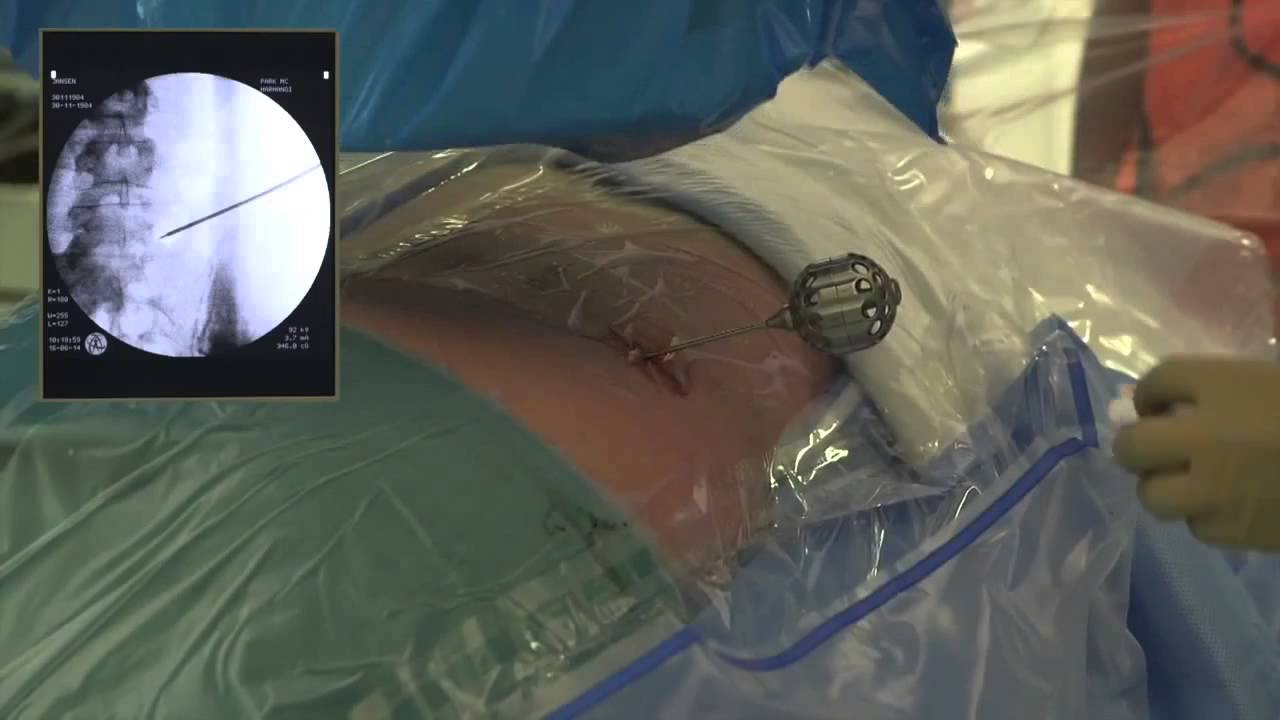 Percutaneous Transforaminal Endoscopic Discectomy (10 min) - Dr ...