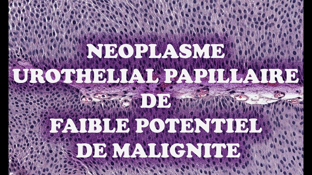 LE NEOPLASME PAPILLAIRE UROTHELIAL DE FAIBLE POTENTIEL DE MALIGNITE ...