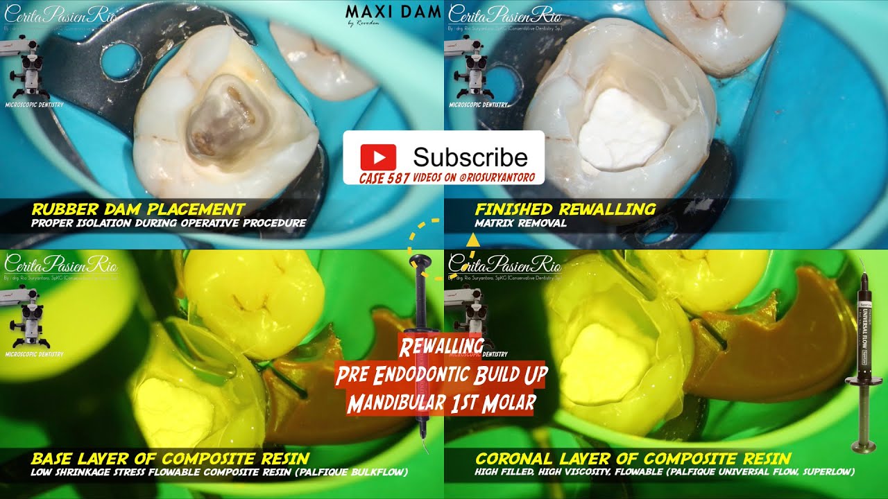 REWALLING PRE ENDODONTIC BUILD UP MOLAR PALFIQUE UNIVERSAL FLOW SUPER ...