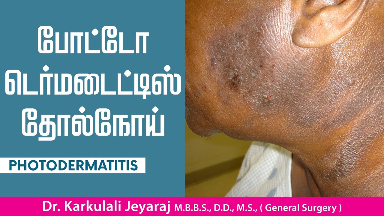 போட்டோ டெர்மடைட்டிஸ் | Photodermatitis Skin Diseases Treatment and ...