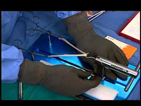 2Anterior Cruciate Ligament Reconstruction Using TransFix - YouTube