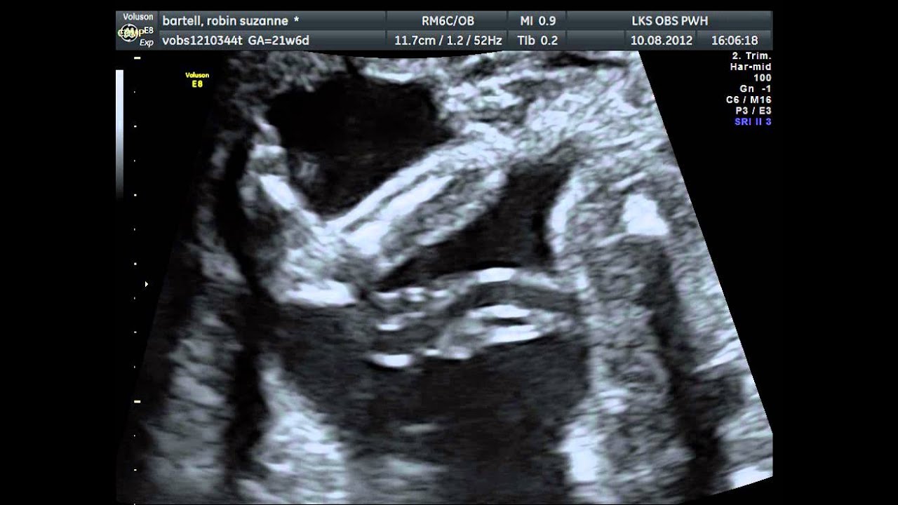 Baby Bartell's Little Feet - 21 week ultrasound - YouTube
