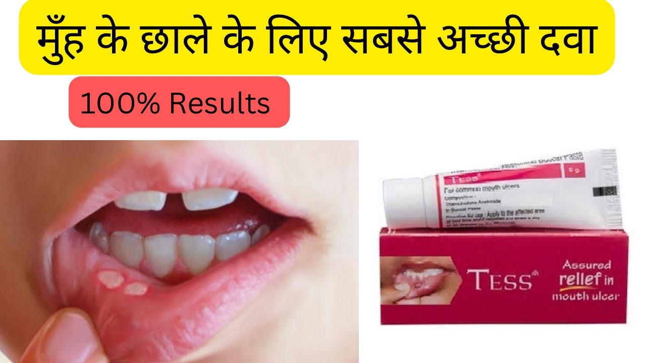 Tess oral paste| मुँह के छाले के लिए पेस्ट| ⁠ ⁠ Triamcinolone paste ...
