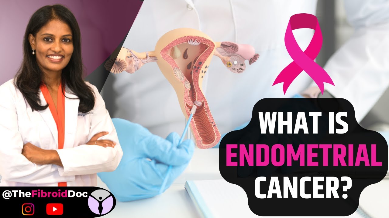 What Is Endometrial Cancer? - TheFibroidDoc. - YouTube