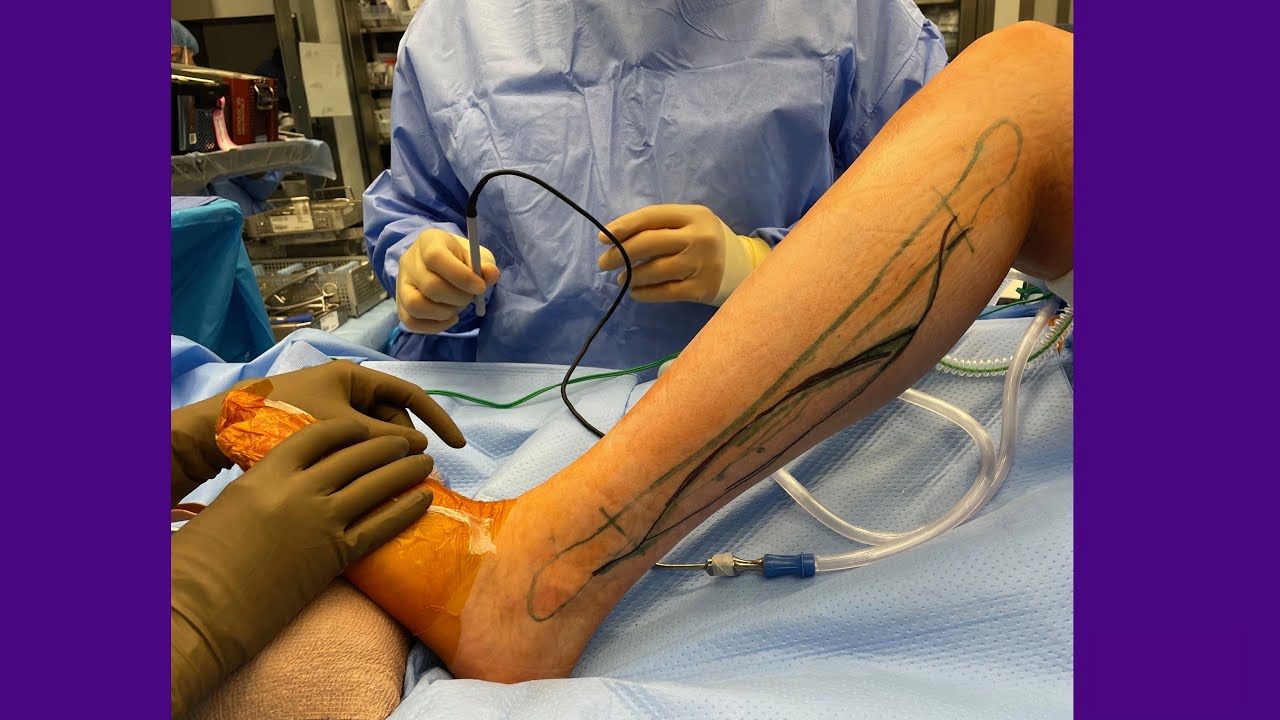 Distal Tibia Intercalary Reconstruction with Modified Capanna Technique ...