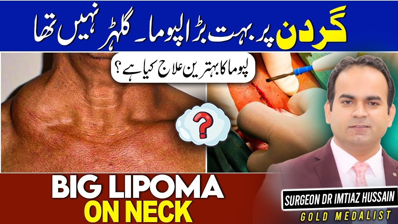 Lipoma on Neck | Examination & Treatment Options | Surgeon Dr Imtiaz ...
