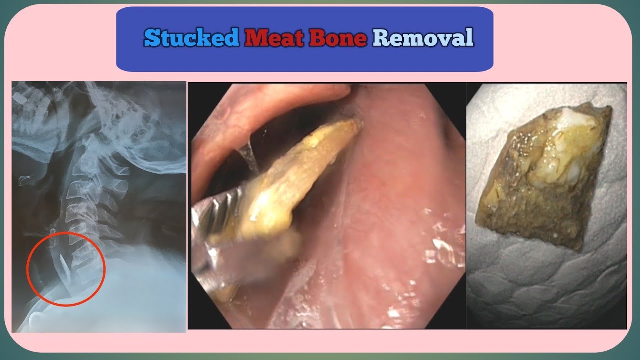 Stucked Meat Bone Removal #BD_ENDOSCOPY - YouTube