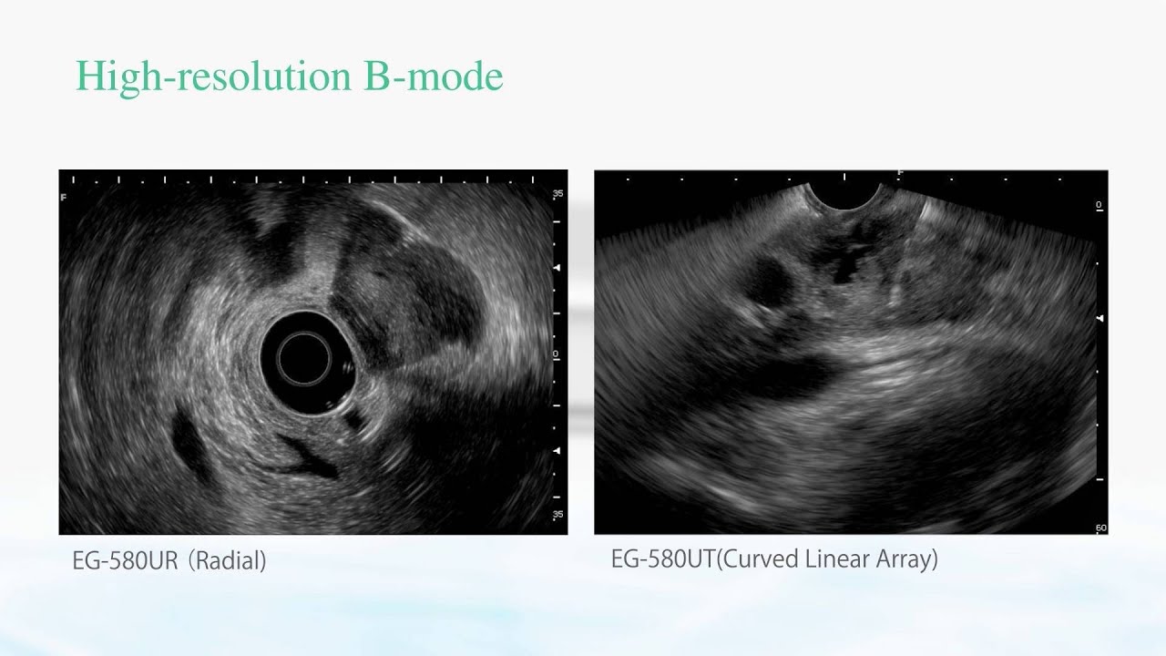 Fujifilm SU1 - Endoscopic Ultrasound System - YouTube