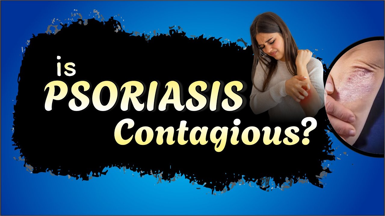 Is Psoriasis contagious ? | Ayurveda Treatment for Psoriasis ...