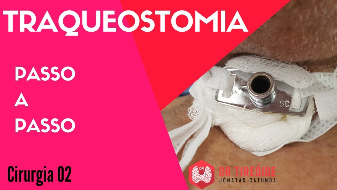Traqueostomia - Cirurgia #02# Passo a passo | Dr Jônatas Catunda - YouTube