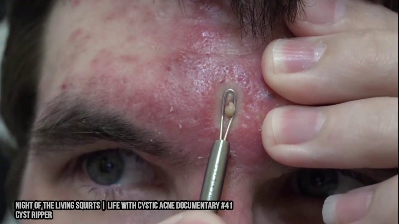 666 Pimples, Cysts, Blackheads and Comedones. Pimple Popping Fever ...