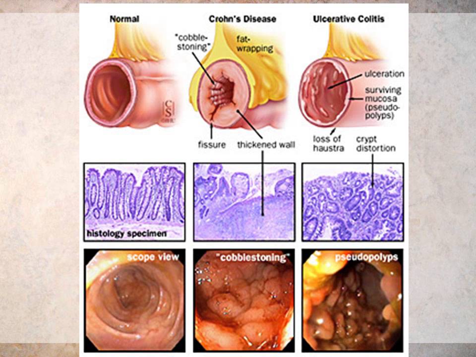 Pathology Part-6 * Inflammatory Bowel Disease * Dr. Mumtaz Sajjd, MD ...