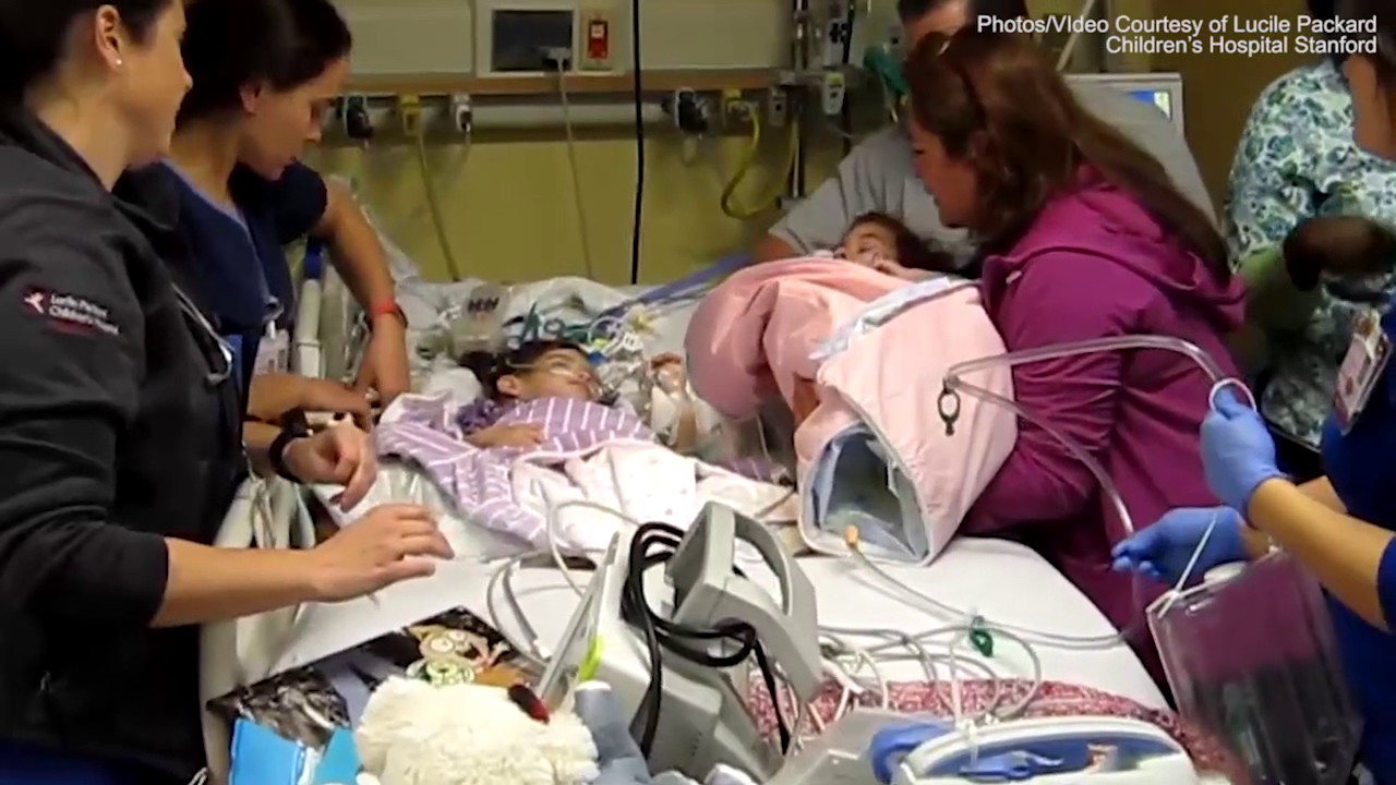 The moment conjoined twins see each other after separation - YouTube