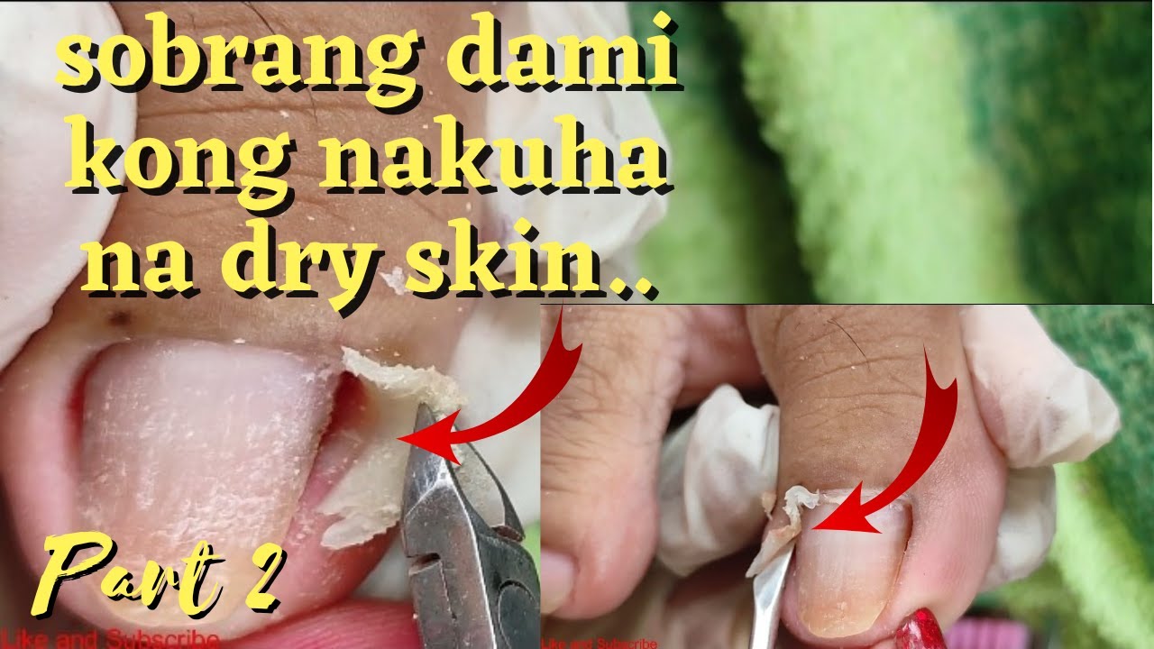 Vlog 494|Dry Skin/Ingrown Removal| PEDICURE 394 - YouTube