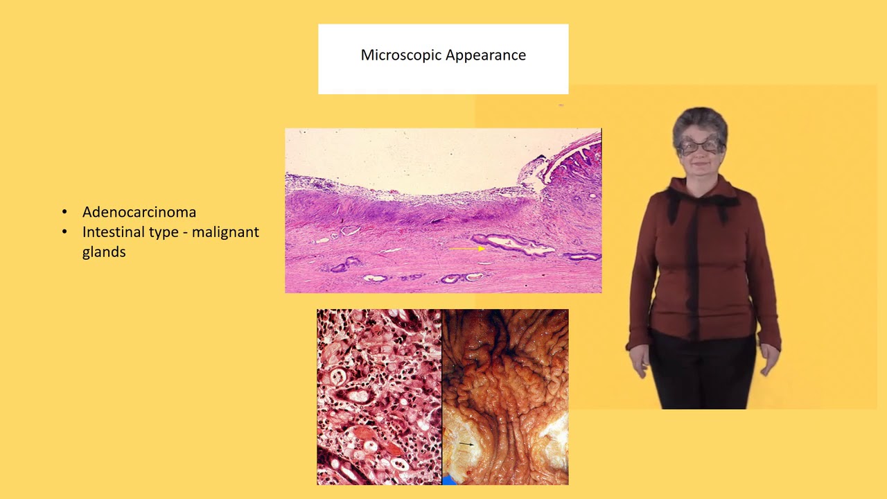 Upper GI pathology - YouTube