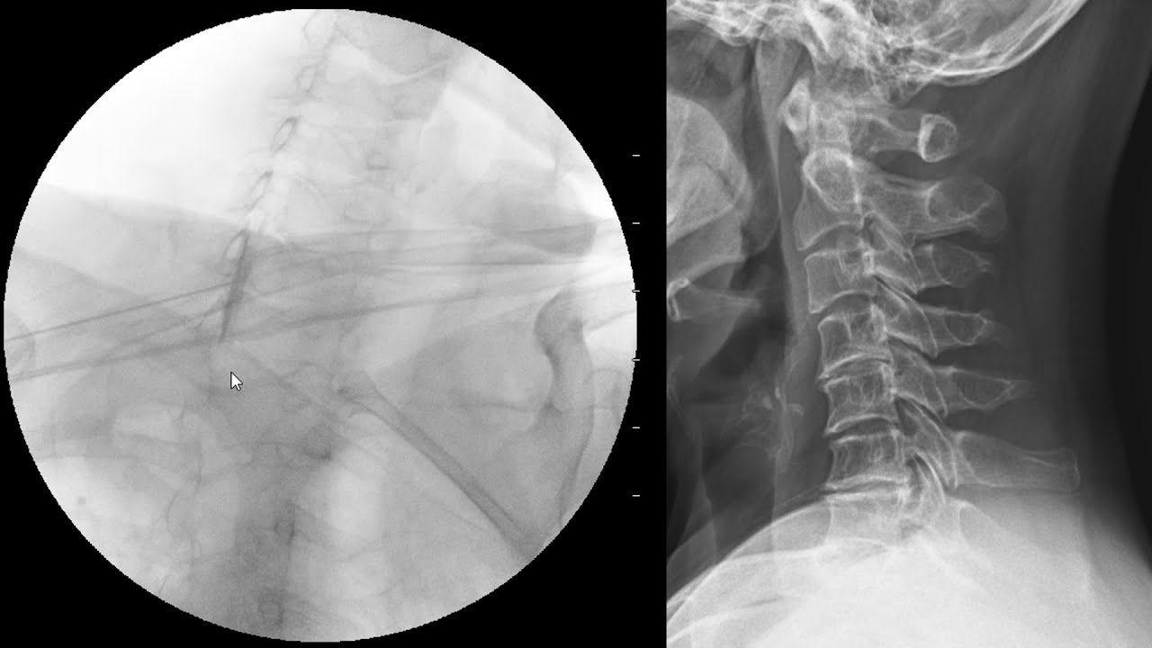 CESI 정확하게 하는 방법 (3) Cervical epidural steroid injection - YouTube