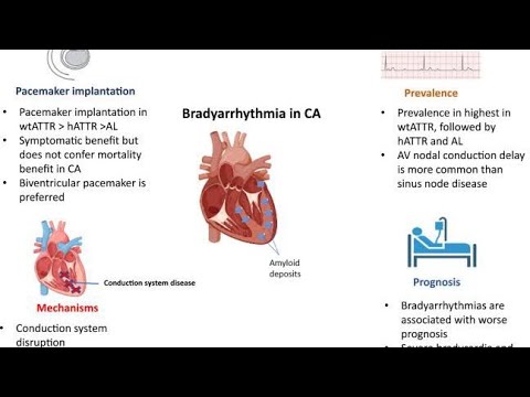 Bradyarrhythmias or Bradycardia / Sinus bradycardia / Bundle branch ...