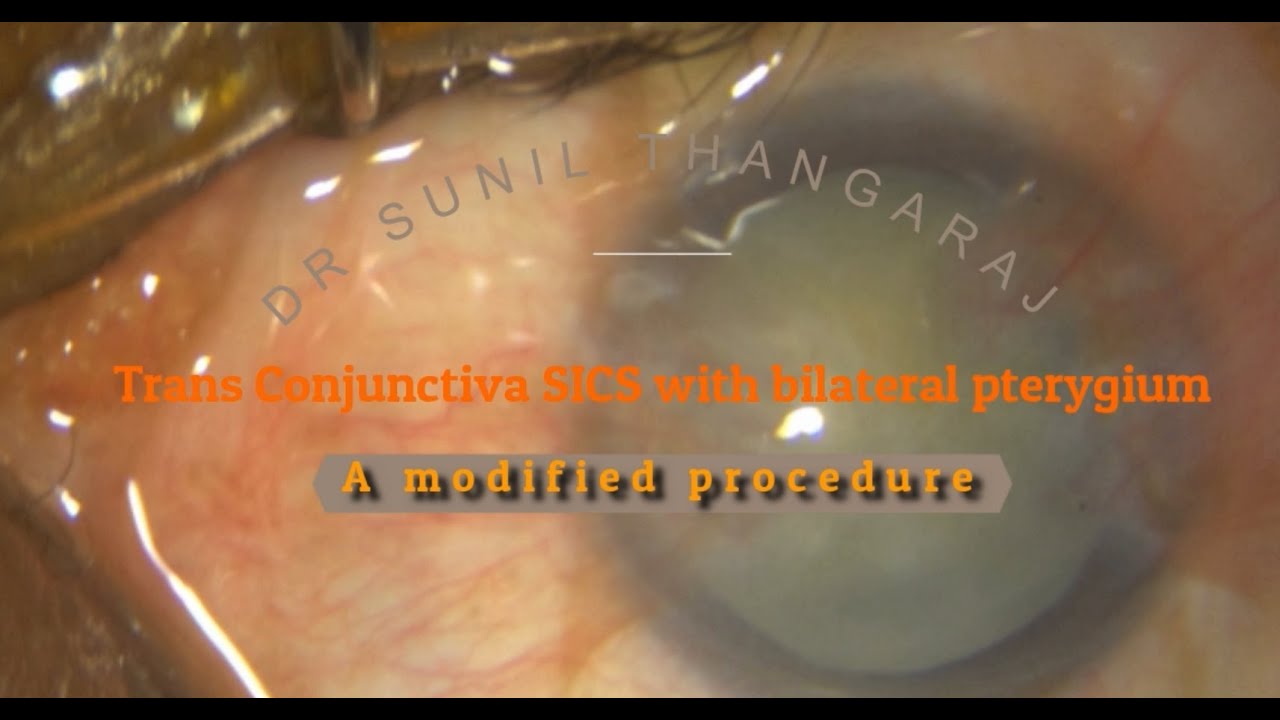 Advanced cataract with bilateral pterygium - managed by TCSICS ...