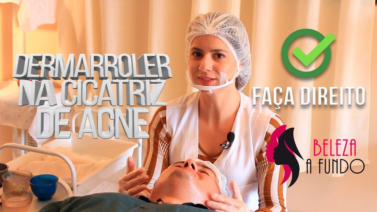 MICROAGULHAMENTO NA CICATRIZ DE ACNE - YouTube