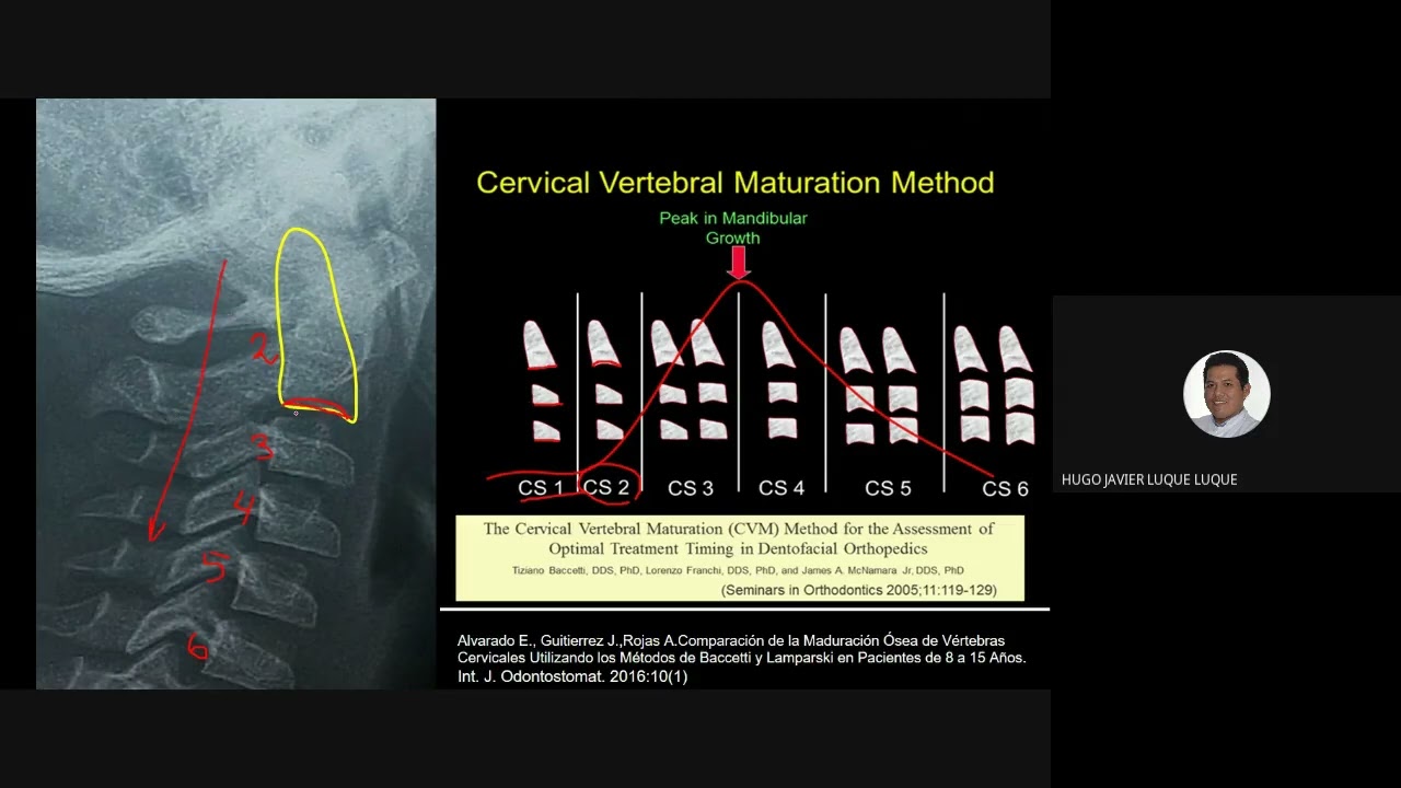 12 ANÁLISIS DE VÉRTEBRAS CERVICALES - YouTube
