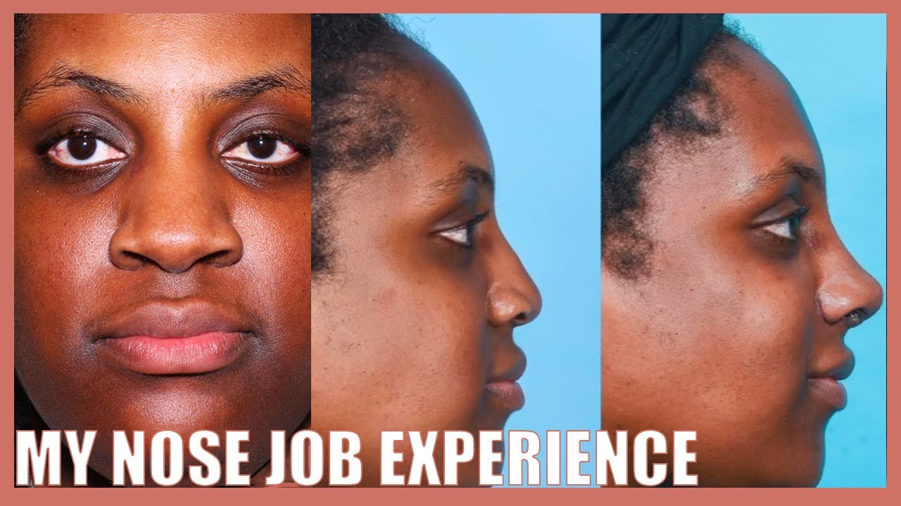 VLOG| My Nose Job Experience - YouTube