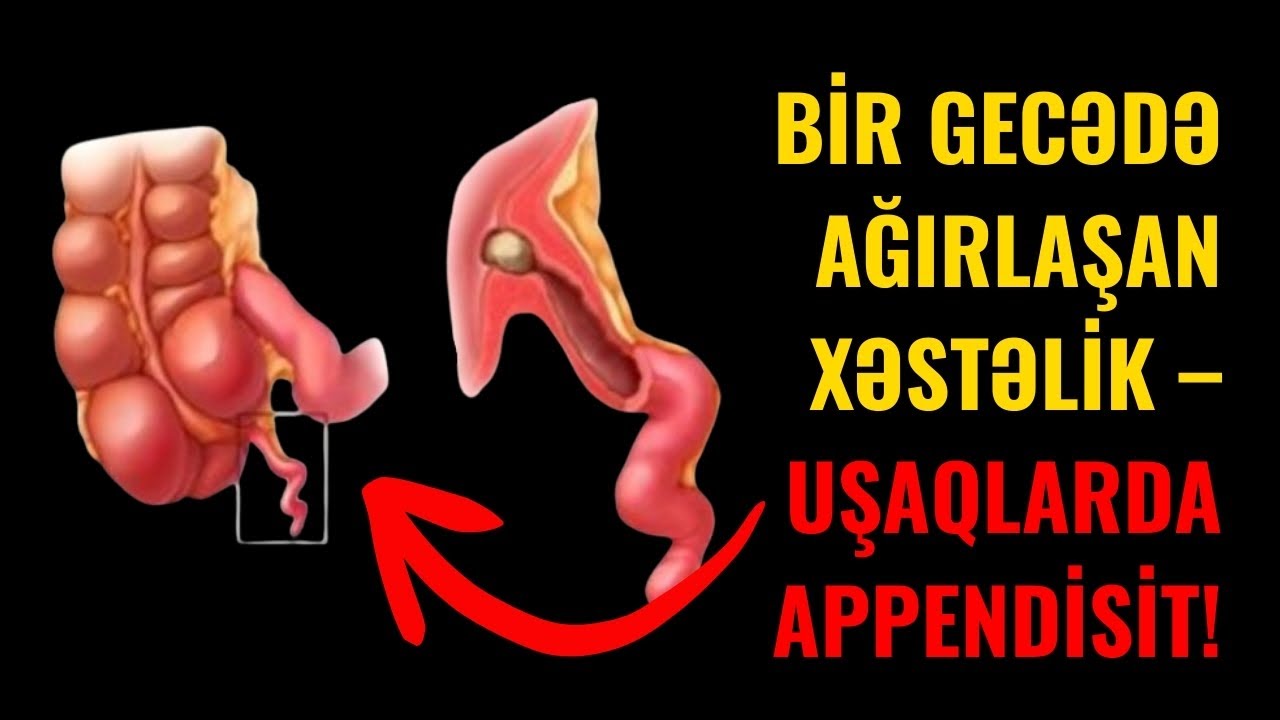 Sadə qarın ağrısı deyil! Uşaqlarda appendisit təhlükəsi - YouTube
