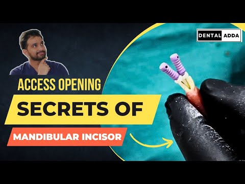 Mandibular Central Incisor!! access opening and Working length ...