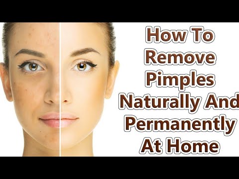 4 simple steps to remove pimples and get clear spotless skin!!! - YouTube