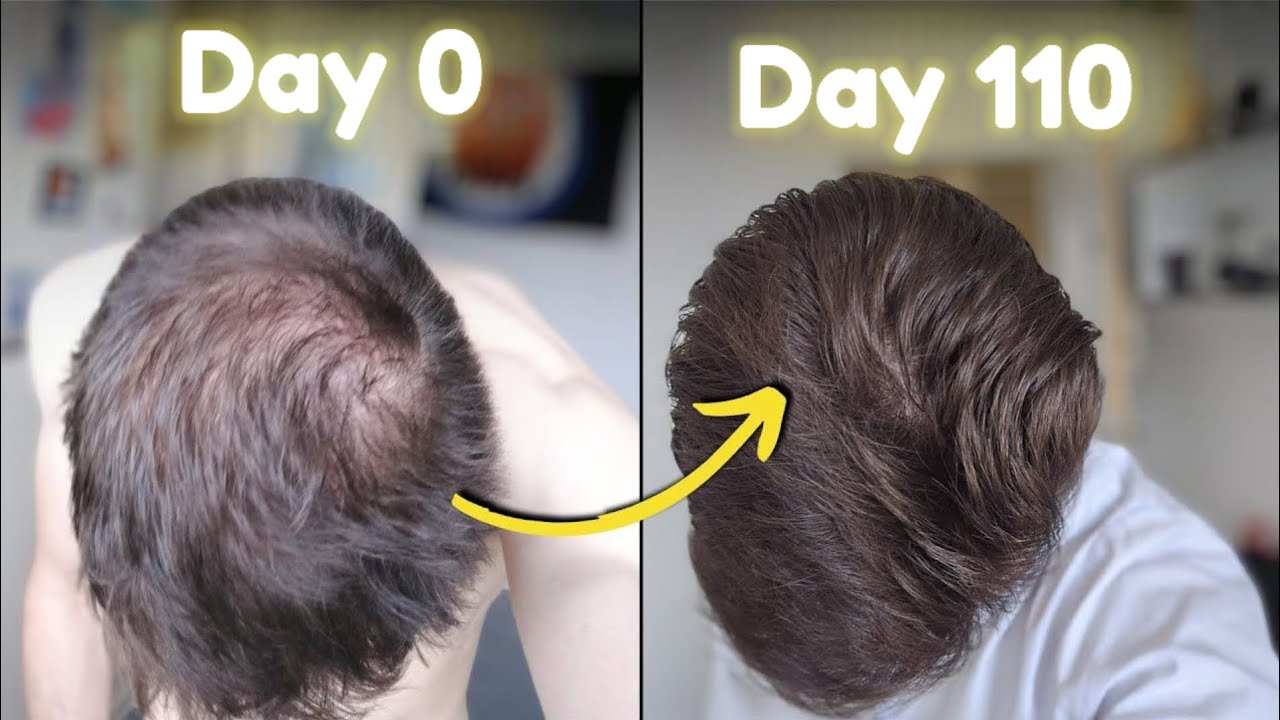 "110 Days of Minoxidil: Shocking Hair Regrowth Transformation! (Before ...