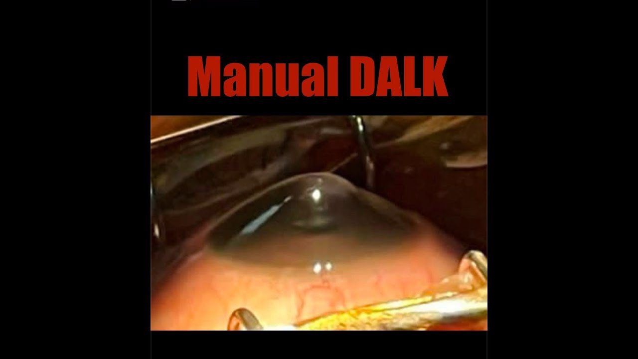 Manual DALK in a case of advanced Keratoconus with scar - YouTube