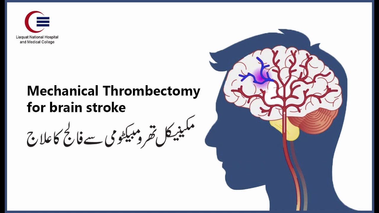 Mechanical Thrombectomy for brain stroke - YouTube